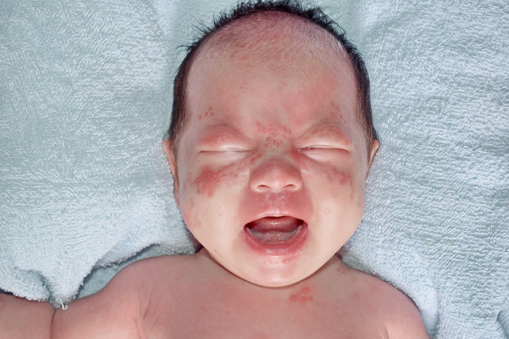 An Infant With Rash | Wyeth Nutrition Science Center Philippines